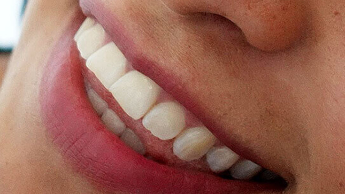 Cracked Teeth From Grinding